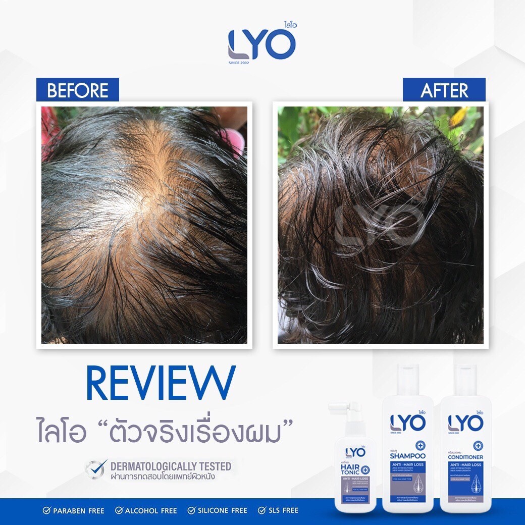 LYO ไลโอ โปรพฤษภาคม65 (1แถม2) ลดผมร่วง สร้างผมใหม่ บำรุงรากผมให้แข็งแรง ชลอผมหงอก โดยคุณหนุ่ม ...