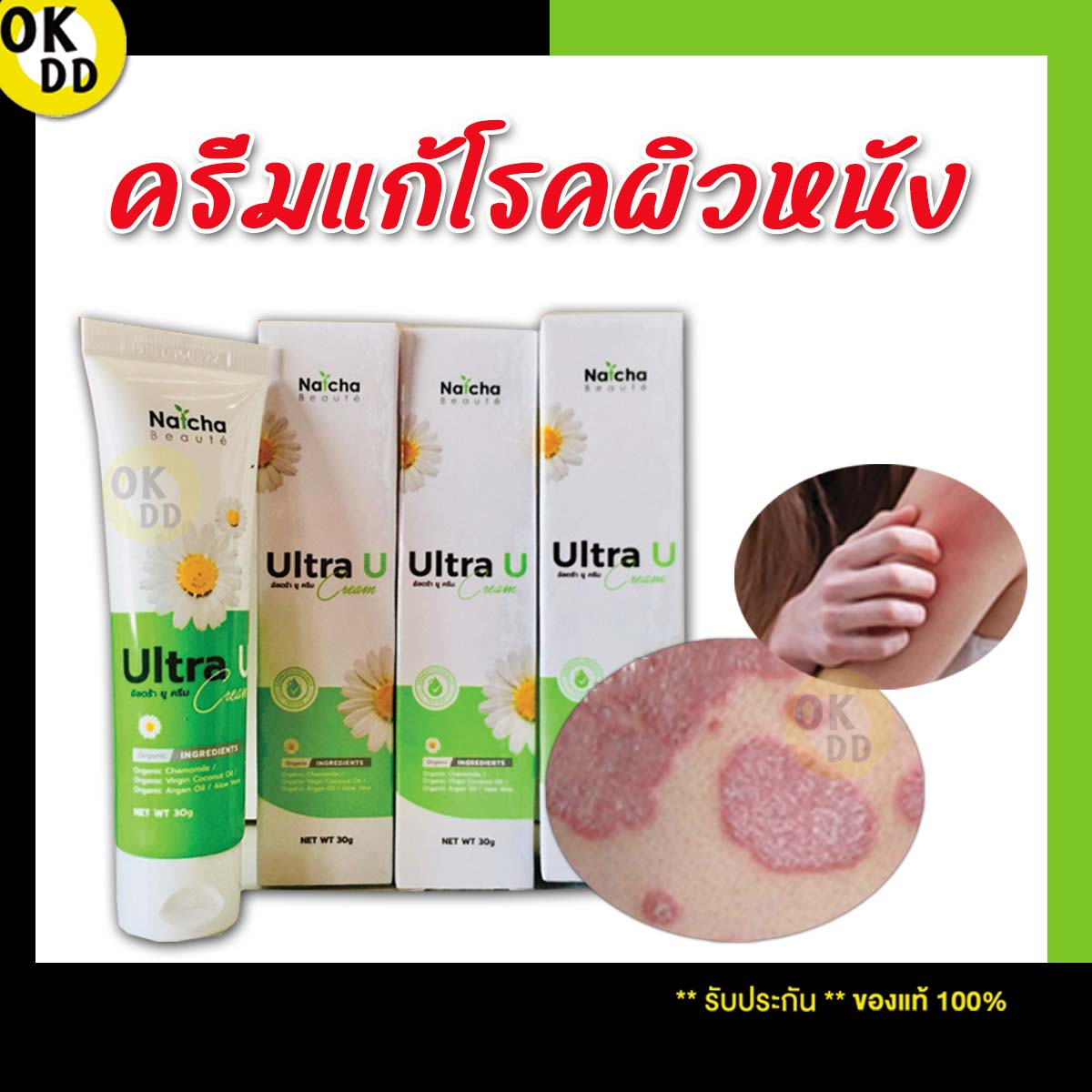 ของแท้/พร้อมส่ง!! [3หลอด] UltraU อัลตร้ายู ครีมแก้คัน ครีมโรคผิวหนัง ครีมโรคกลากเกลื้อน เชื้อรา ...
