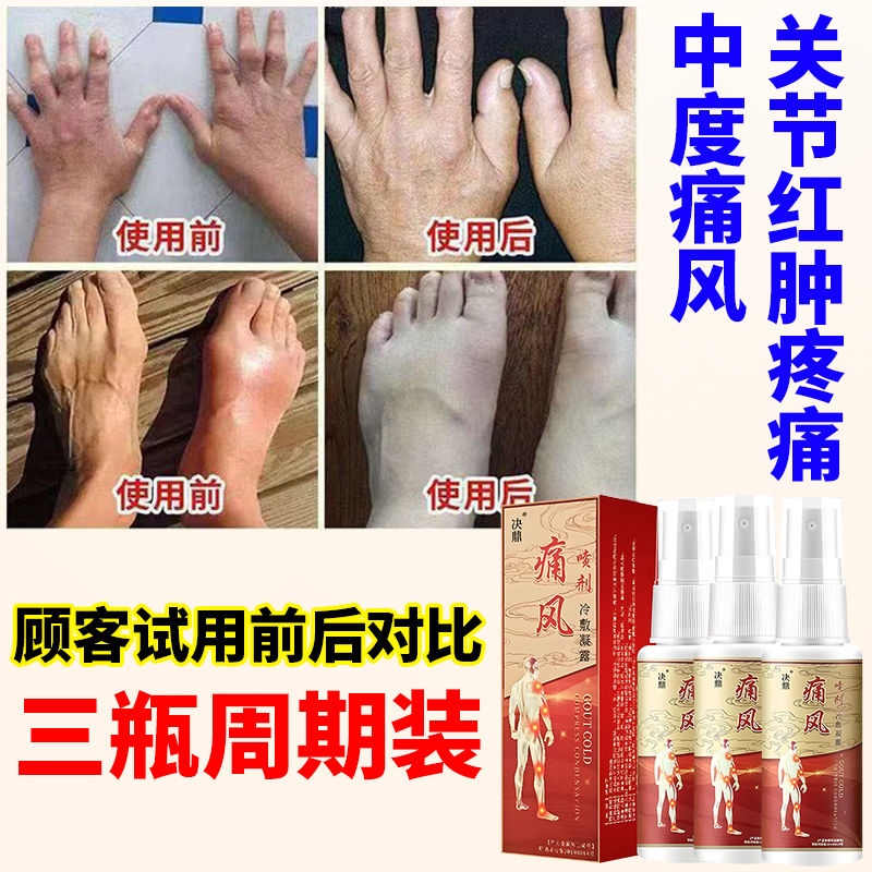 [Not Afraid Of Alcohol] Gout Ointment Special Effect Spray Cold ...
