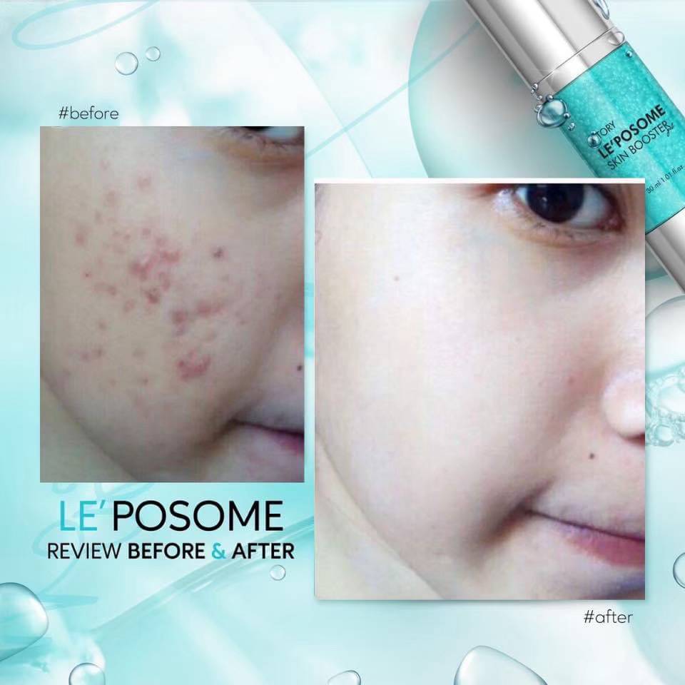 เลอโปรโซม Le'Posome โปรโมชั่น 3 ขวดลดเหลือ 1,000฿ / เลอโปรโซม ไฮยาบูสเต ...