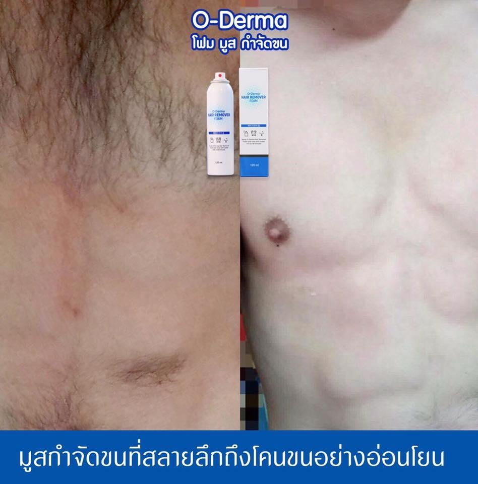 โอเดอร์มา แฮร์ รีมูฟเวอร์ โฟม O-Derma Hair Remover Foam (120ml) (X10) - Tongnoi Shop - ThaiPick