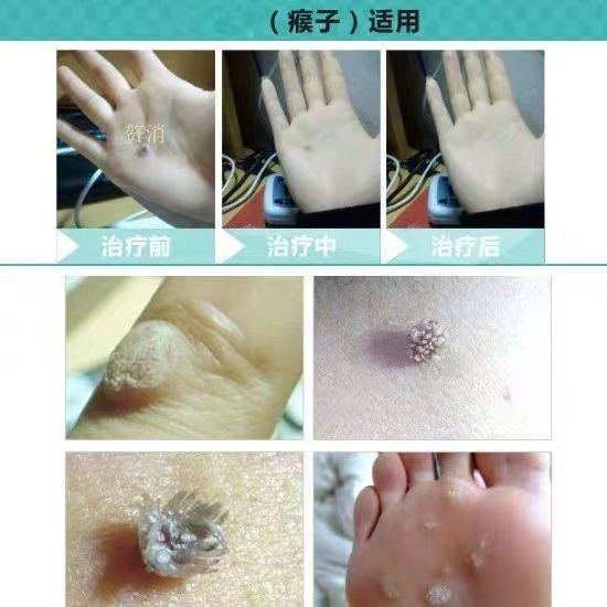 Remove facial verruca plana neck alar filamentous warts flesh thorn ...