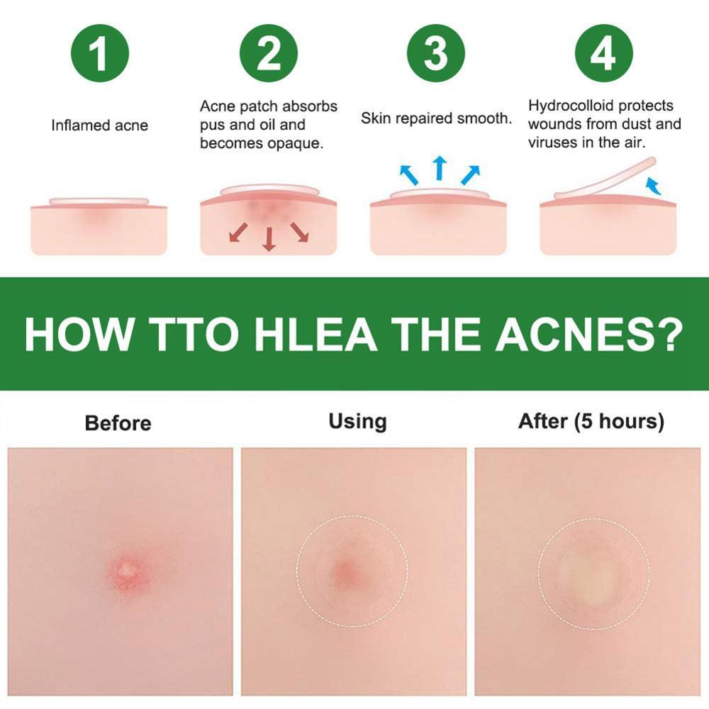 (แท้) Tea Tree Acne Pimple Patch Hydrocolloid Waterproof Clear Pimple ...