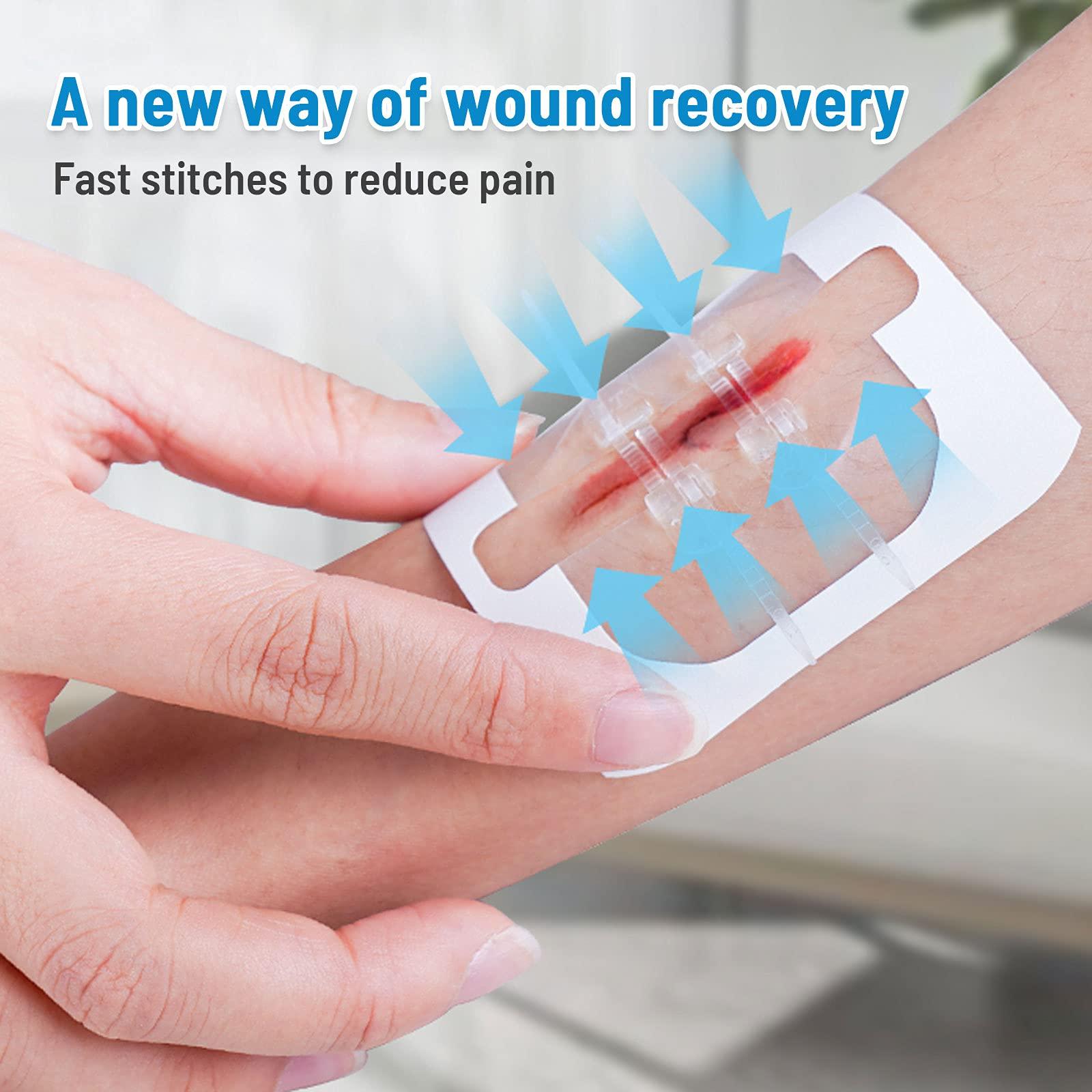 URIT 246 Pcs Zipper Band-aid Painless Wound Closure Device Suture-free ...