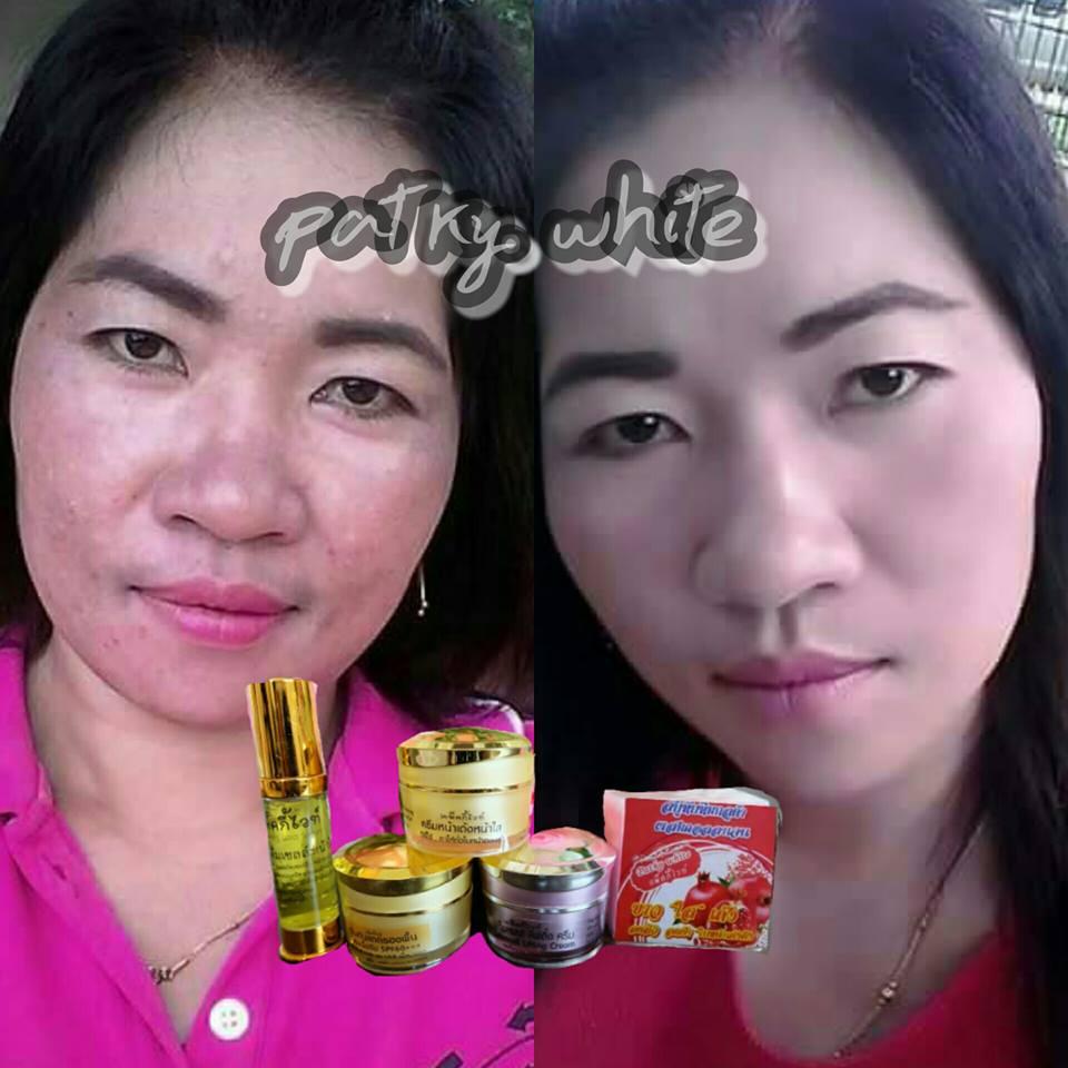 Patky White (แพ็คกี้ไวท์) / ชุดครีมแก้ฝ้า กระ จุดด่างดำ ริ้วรอย หลุมสิว ร่องลึก รอยตีนกา ...