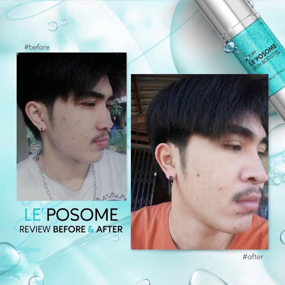 เลอโปรโซม Le'Posome โปรโมชั่น 3 ขวดลดเหลือ 1,000฿ / เลอโปรโซม ไฮยาบูสเต ...