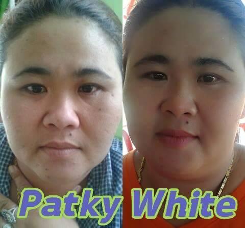 Patky White (แพ็คกี้ไวท์) / ชุดครีมแก้ฝ้า กระ จุดด่างดำ ริ้วรอย หลุมสิว ร่องลึก รอยตีนกา ...