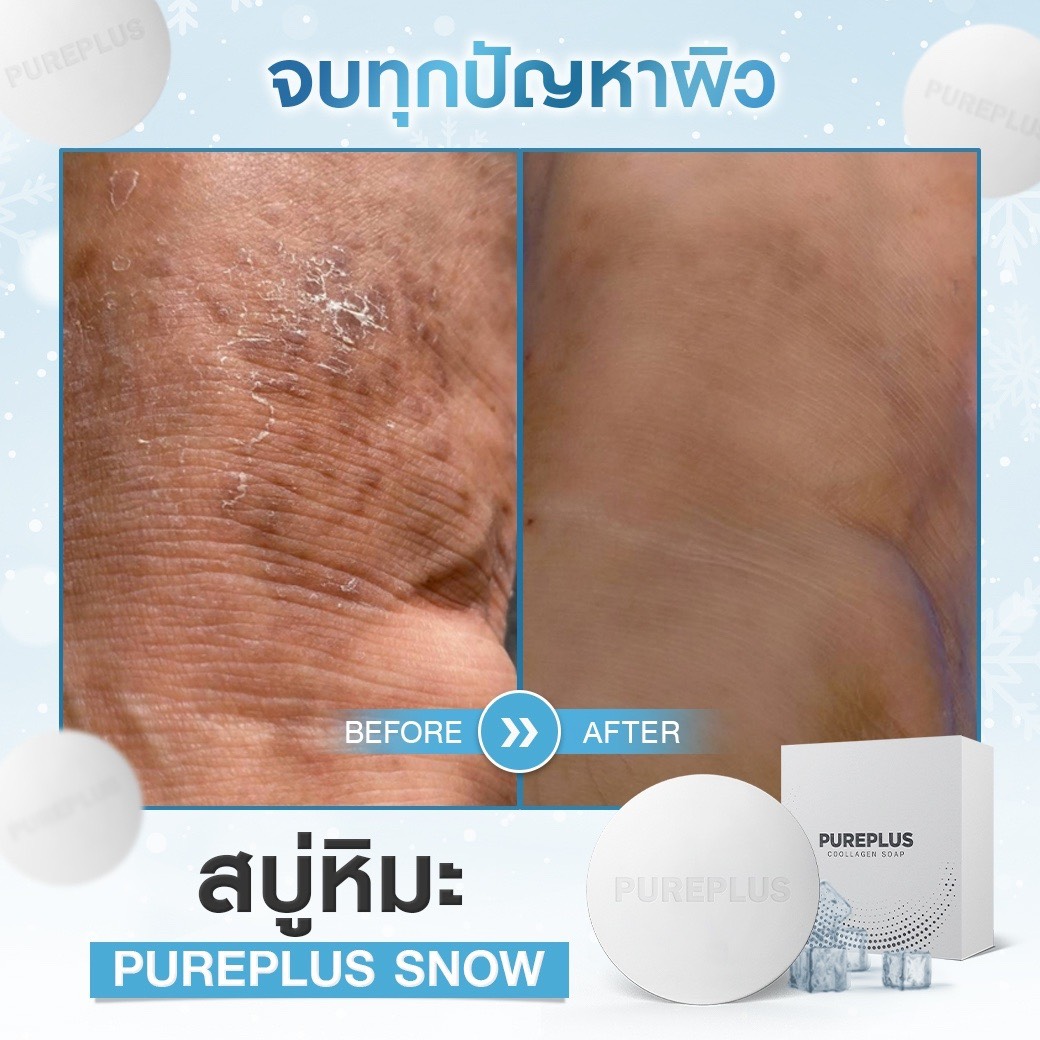 PUREPLUS Coollagen Snow : สบู่หิมะ ลดสิว ผิวเด้ง ขาวใส 3 ก้อน 500.- ส่งฟรี - Pureplus Thailand ...