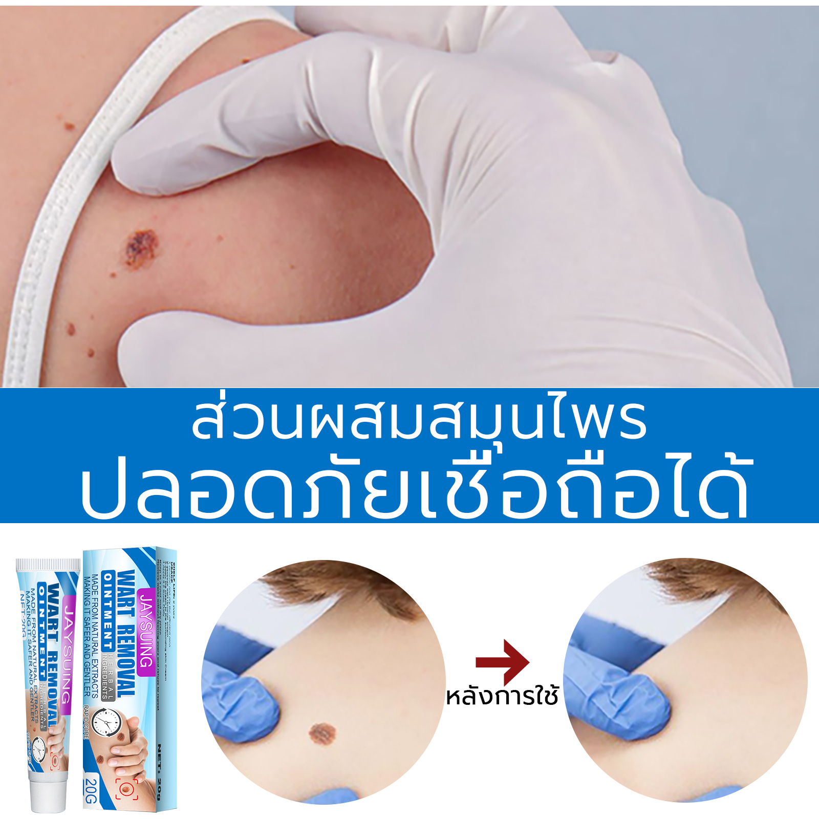 ลอกหูดตาปลา รักษาตาปลา ขจัดติ่งเนื้อ เห็นผลทันทีเมื่อใช่ต่อเนื่อง ขนาด ...