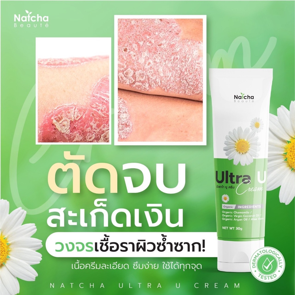 รอยดำยุงกัดหายได้ Ultra U อัลตร้ายู ครีมทาสะเก็ดเงิน กลาก เกลื้อน น้ำ ...