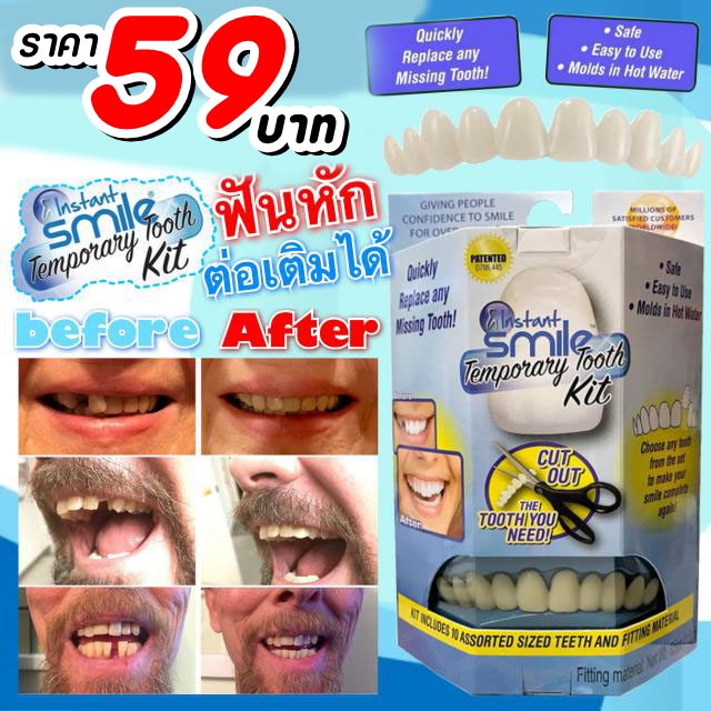 instant smile temporary tooth kit ซ่อมแซมฟันหัก เร่งด่วน ฟันปลอมฉุกเฉิน ...