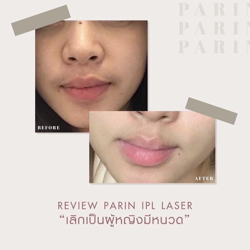 PARIN IPL LASER : เครื่องเลเซอร์กำจัดขน 600000 ช็อต / COLOR : ROSE GOLD ...