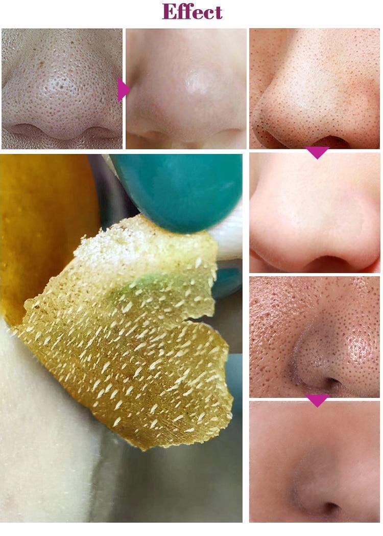 RtopR gold blackheads and whiteheads removal facial mask มาร์คหน้ารักษา ...