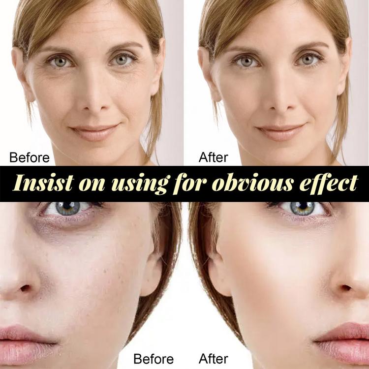 Protein Thread Lifting Kit Absorbable Collagen Thread Gold Protein ...