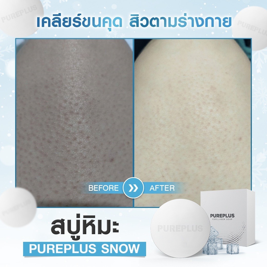 PUREPLUS Coollagen Snow : สบู่หิมะ ลดสิว ผิวเด้ง ขาวใส 3 ก้อน 500.- ส่งฟรี - Pureplus Thailand ...