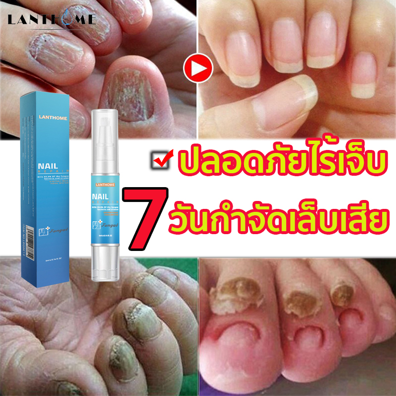 Lanthome ปากกาเล็บ รักษาเล็บ เล็บเท้าคุณภาพสูงกำจัดเชื้อราที่เล็บ เอ็สเ ...