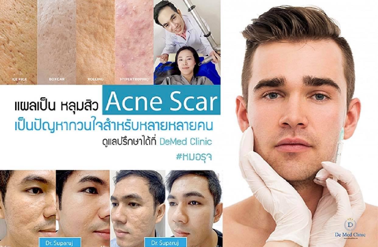 บรรเทาผื่น ผิวหนังอักเสบ Seb Derm ด้วย Sebclair CreamSebclair Cream 30 ...