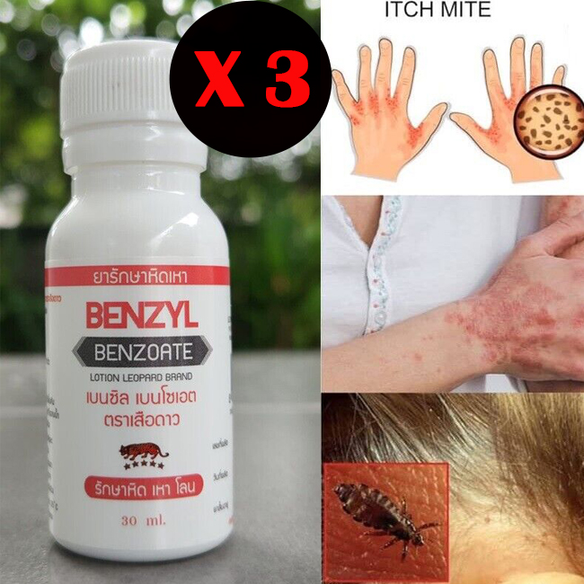 3 SCABIES TREATMENT LOTION MITE & LICE Benzyl Benzoate 25% | Lazada.co.th