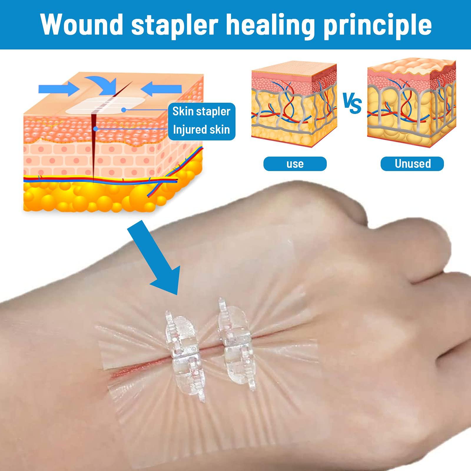 URIT 246 Pcs Zipper Band-aid Painless Wound Closure Device Suture-free ...