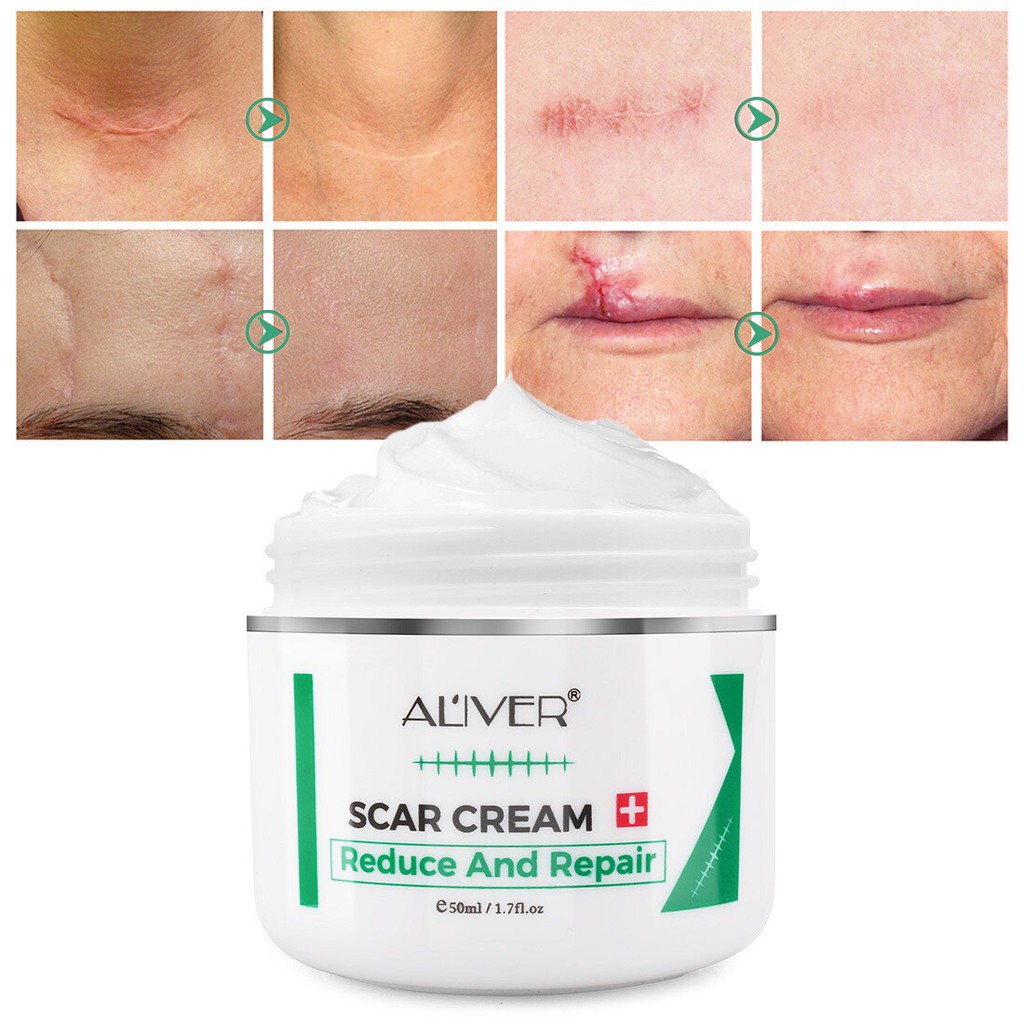ALIVER Repair Scar Scar Cream Remove Stretch Mark Scald Caesarean Bump ...