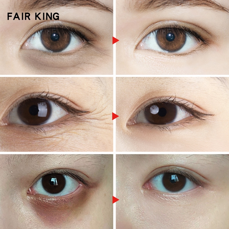 FAIR KING Anti Wrinkle Eye Cream Removes Dark Circles Eye Bags ...