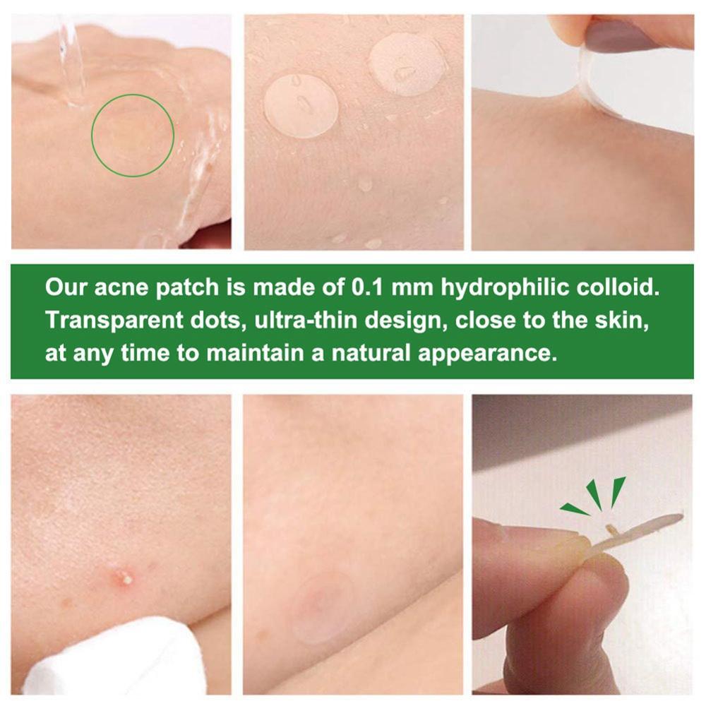 (แท้) Tea Tree Acne Pimple Patch Hydrocolloid Waterproof Clear Pimple ...