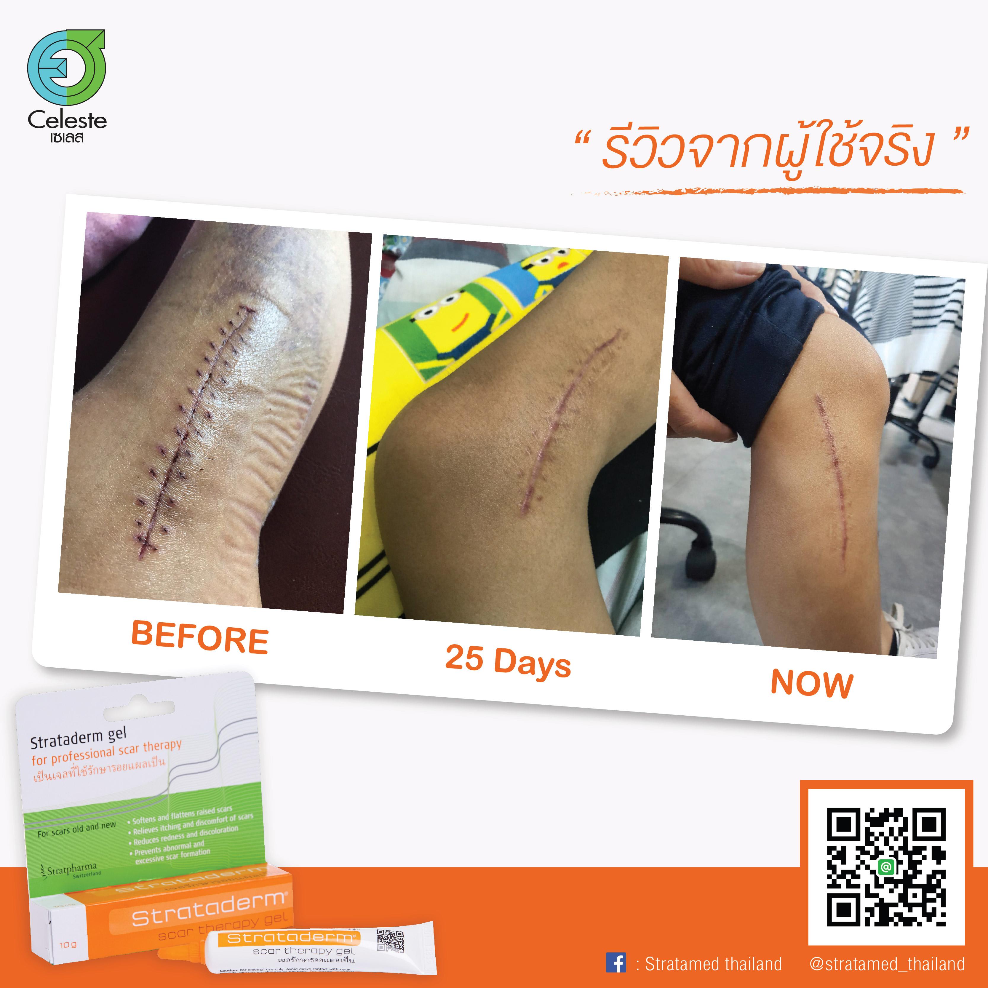 เซทคู่ Strataderm 5 Gel จำนวน 2 หลอด - Celeste_Thailand - ThaiPick