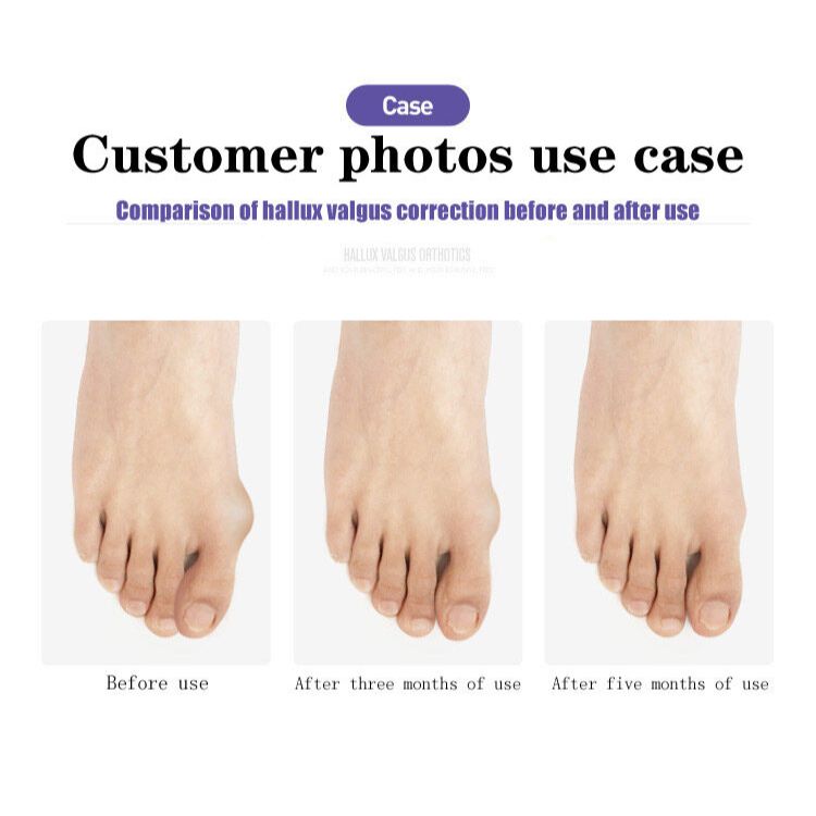 hallux valgus splint correct tones แบบใส่ 2 นิ้ว าซิลิโคนถนอมนิ้วเท้า ...