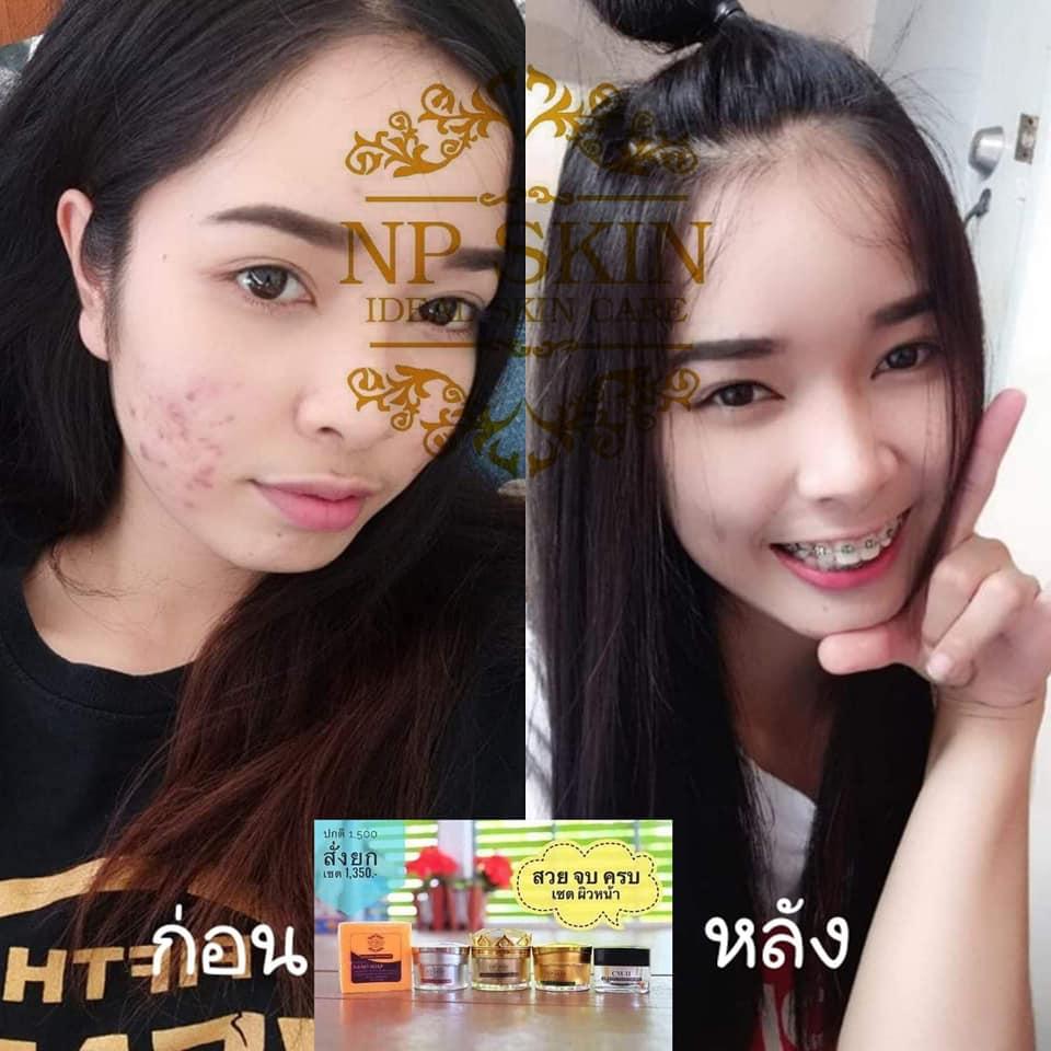 NP SKIN ชุดใหญ่ สวยครบเซ็ต [ไนท์ครีม-เดย์ครีม-ครีมกันแดด-CM-II-สบู่แครอท] ***ส่งฟรี*** - NP SKIN ...