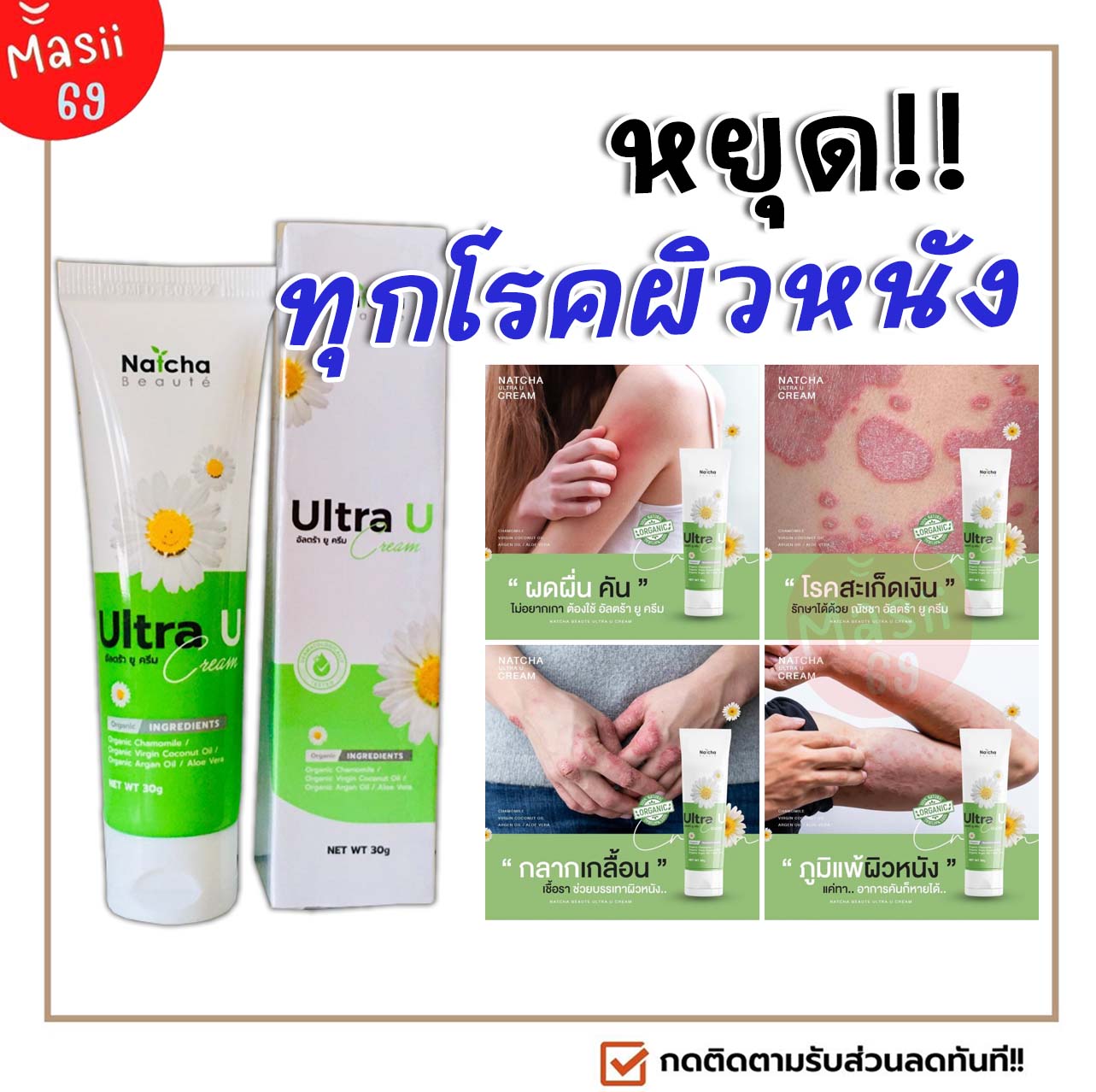 ** ครีมทาภูมิแพ้ผิวหนัง** เซตสุดคุ้ม 2แถม1!! Ultra U อัลตร้ายู ครีมทาเชื้อราที่ผิวหนัง เล็บ กลาก ...