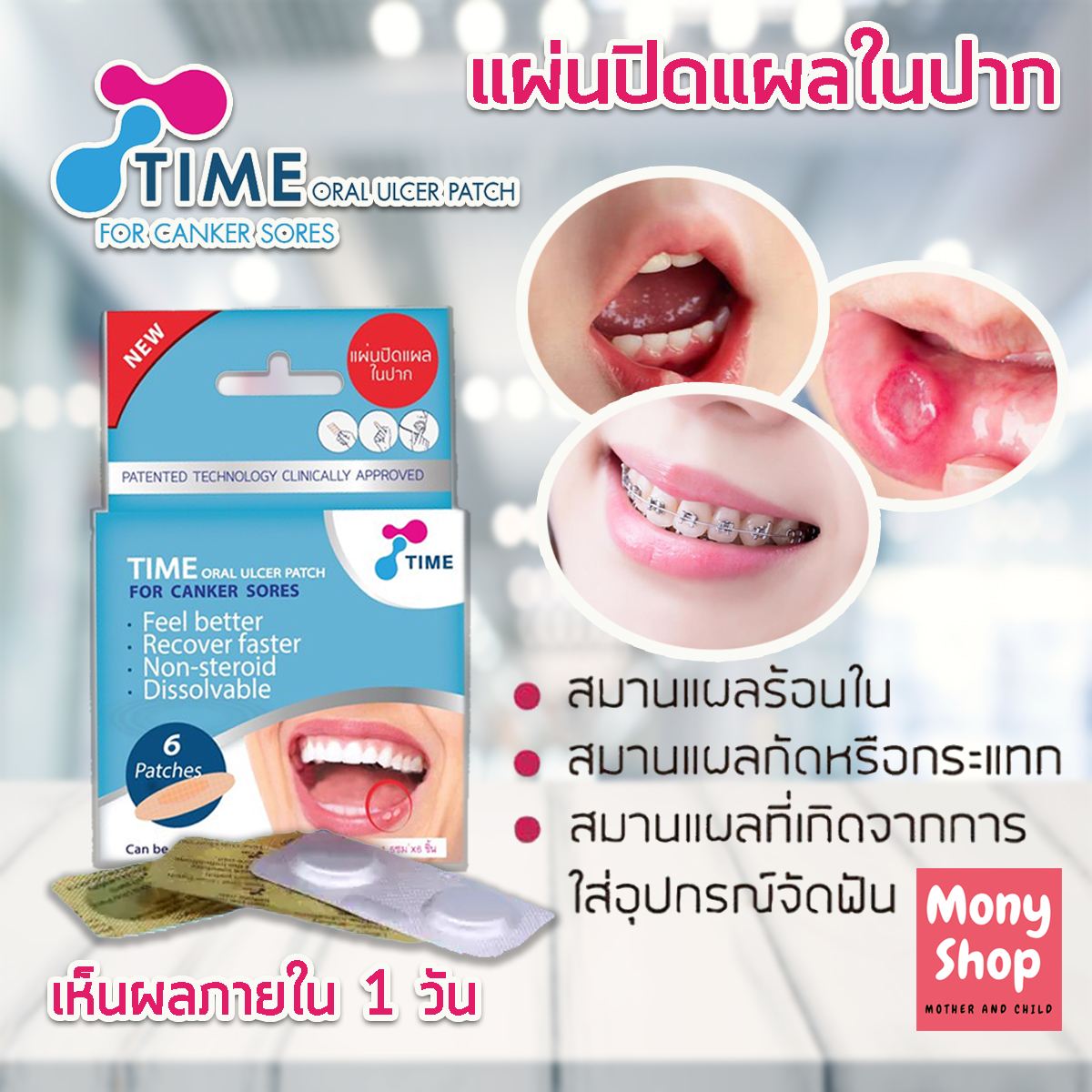 แผ่นแปะแผลร้อนใน แผ่นแปะแก้ร้อนใน Time Oral Ulcer Patch แผลในปาก แผล ...