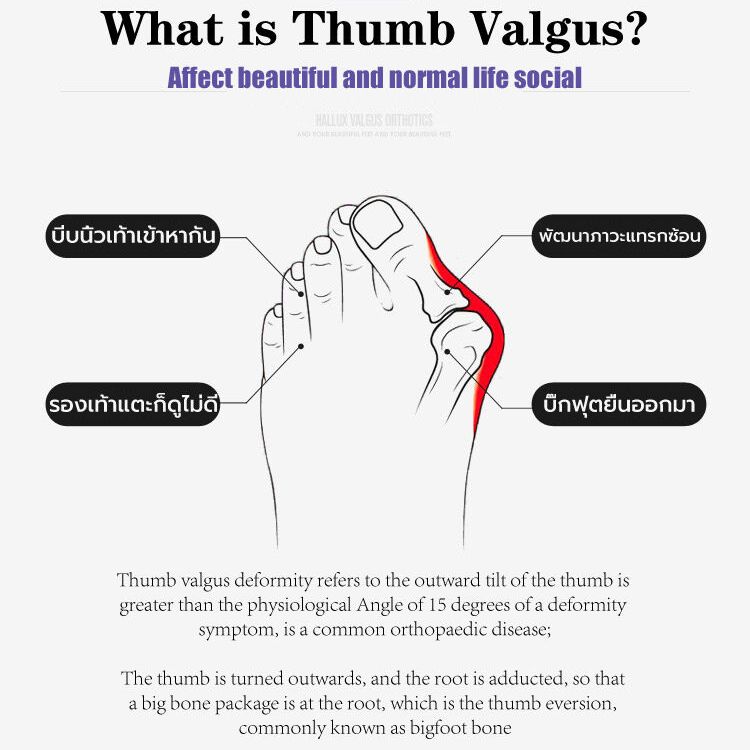 hallux valgus splint correct tones แบบใส่ 2 นิ้ว าซิลิโคนถนอมนิ้วเท้า ...