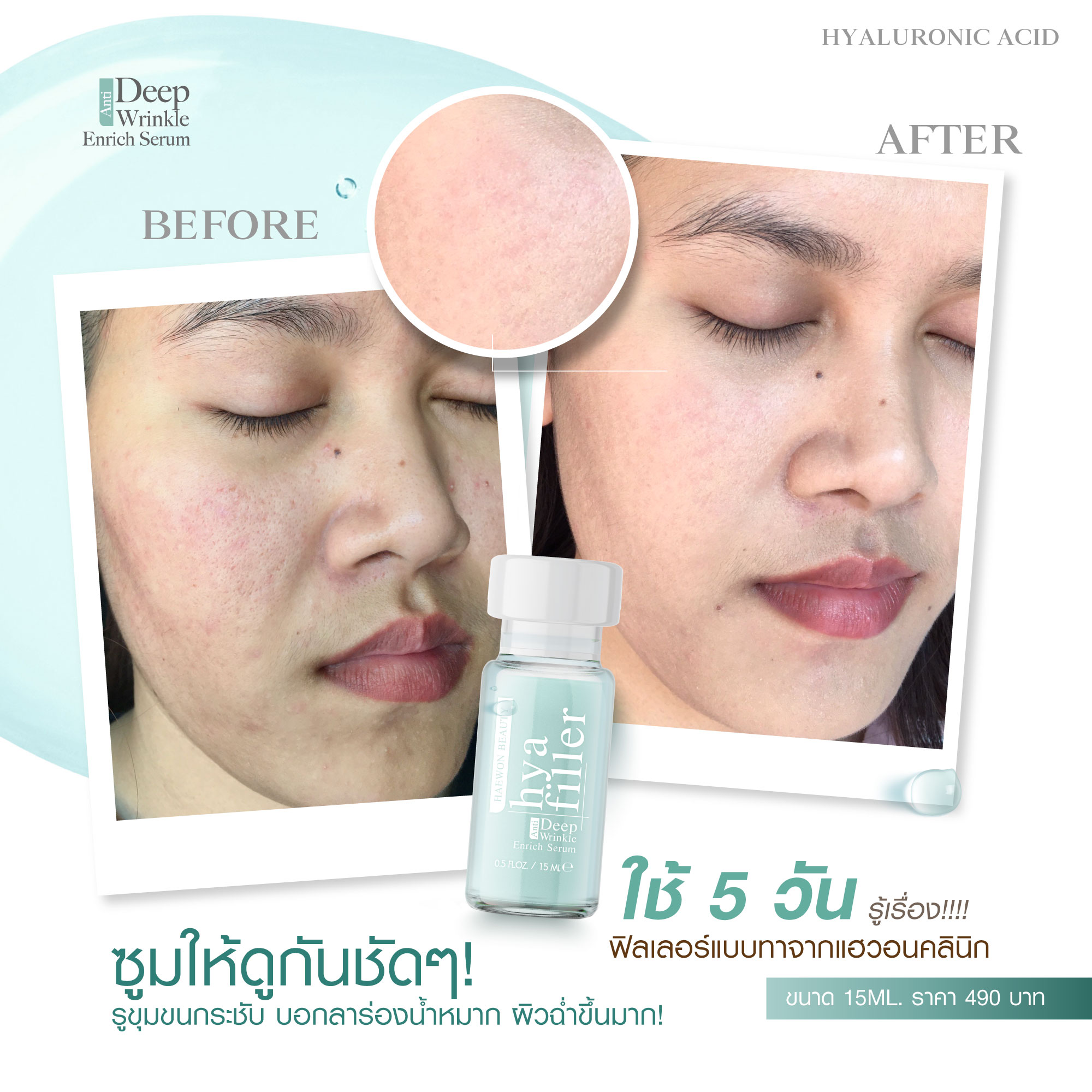 โปร 12.12 ส่งฟรี️ Haewon Hya Filler ฟิลเลอร์แบบทา เซรั่มไฮยา ลดริ้วรอย ...