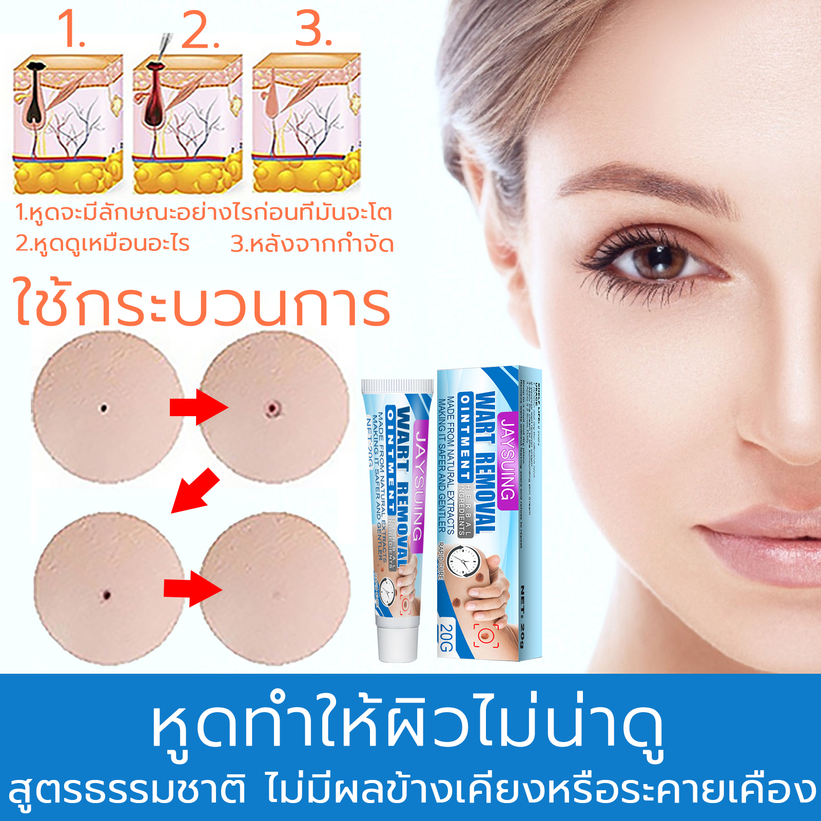 ลอกหูดตาปลา รักษาตาปลา ขจัดติ่งเนื้อ เห็นผลทันทีเมื่อใช่ต่อเนื่อง ขนาด ...