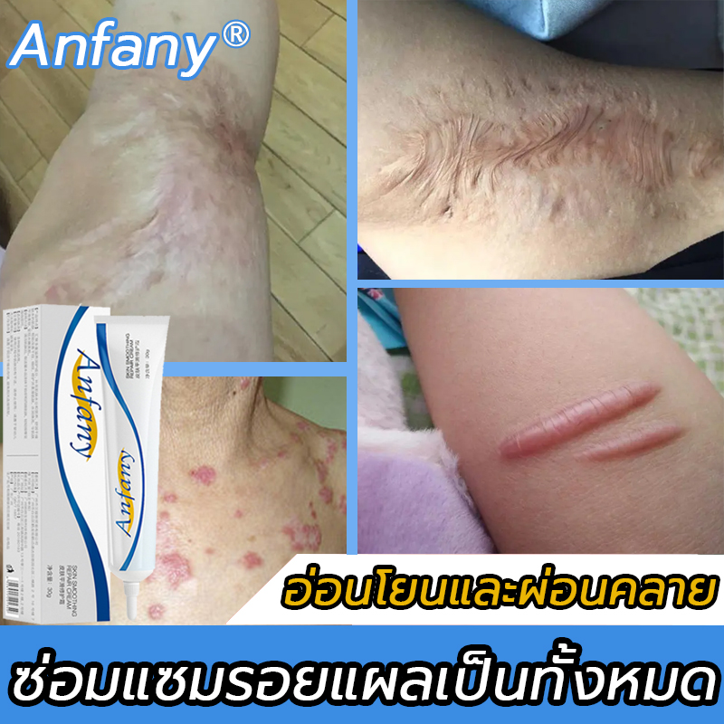Anfany ครี ทาแผลเป็น แผลเป็น ครีมรอยแผลเป็น ครีมทาแผลนูน เจลทารอยแผลเป็น ทาคีลอยด์ ทาลอยแผลเป็น ...