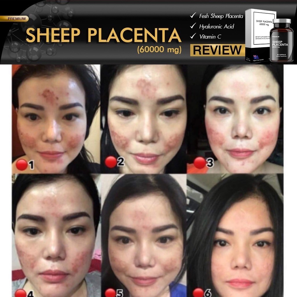 รกแกะ บำรุงผิวให้เเข็งแรง นำเข้าจากออสเตรเลีย Sheep Placenta Australia ...
