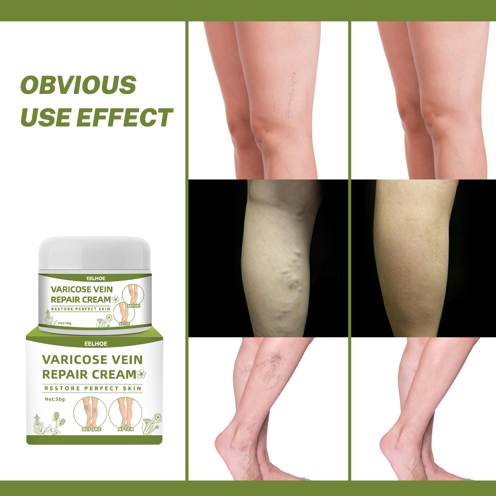 EELHOE Varicose Vein Cream Relief Phlebitis Angiitis Remedy Pain Cream ...