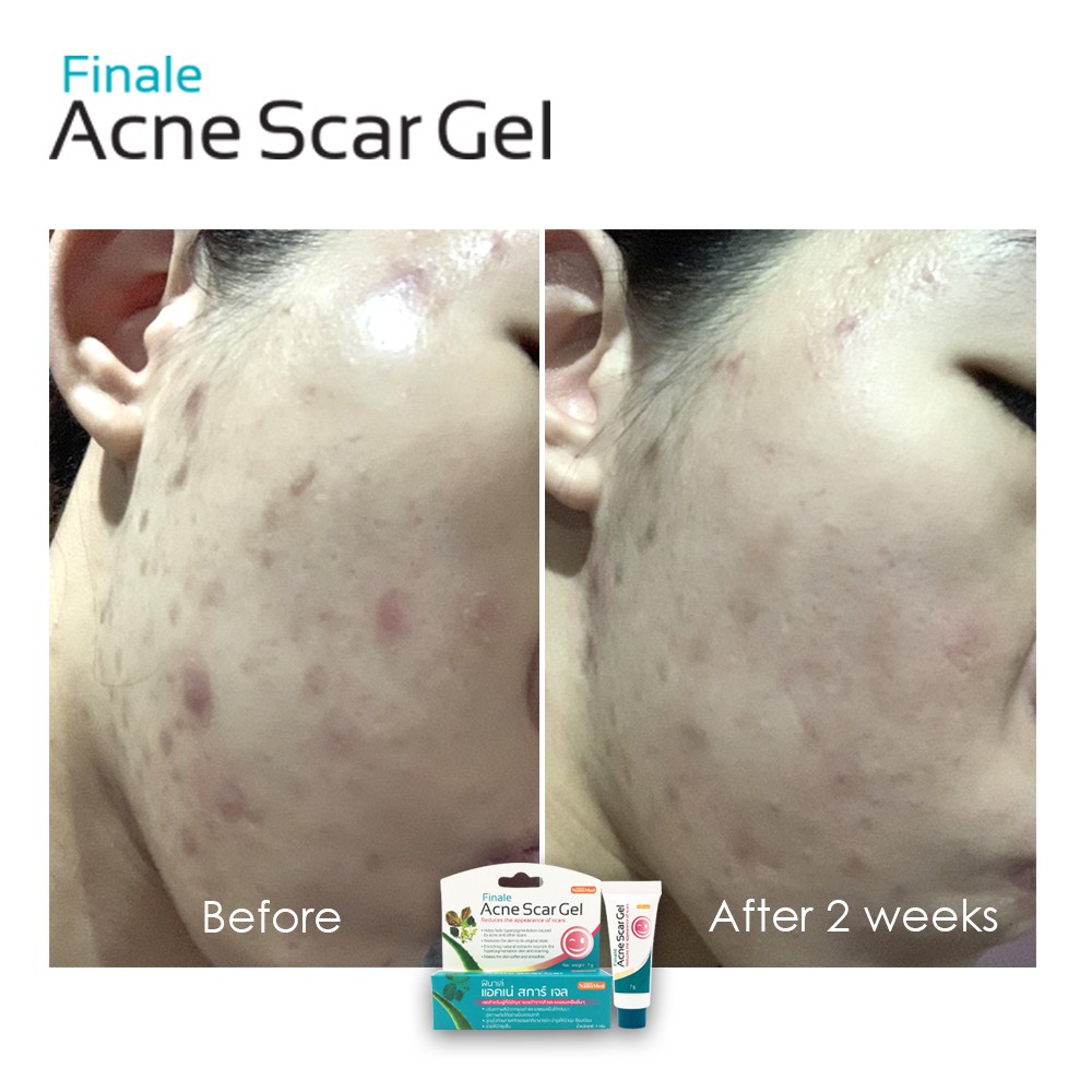 Nanomed Finale Acne Scar Gel เจลรักษารอยดำและแผลเป็น Koriico - Koriico ...