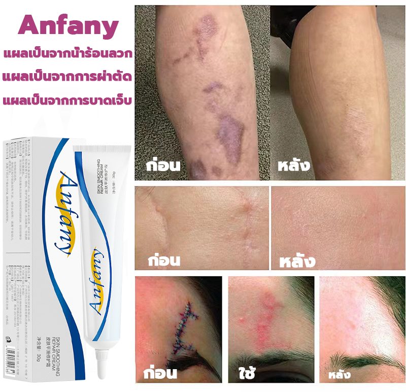 【ส่งจากไทย】Anfany ครีมลดรอยแผลเป็น 30g ครีมทาลบรอยแผล ครีมทาแผลเป็น กำจัดรอยแตกลาย แผลไฟไหม้ น้ำ ...