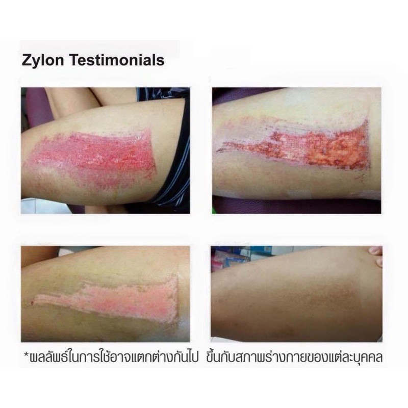 จัดโปรใหญ่ 25cc Zylonไซล่อน แผลหายเร็ว ฆ่าเชื้อสมานแผลป้องกันแผลเป็น ไม่แสบ free delivery ...